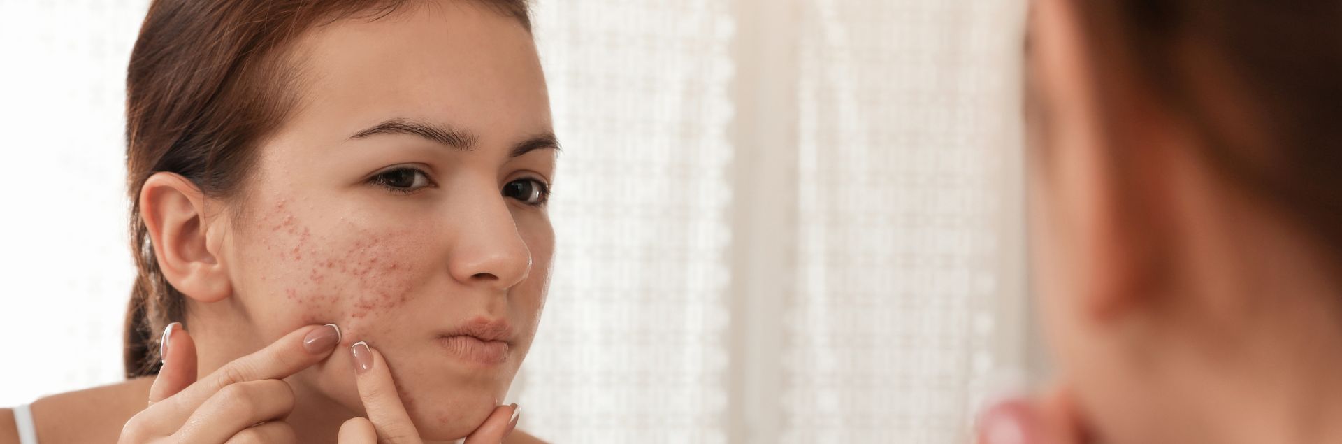 Exploring Effective Acne Scar Treatments for Each Skin Type | The Skin ...